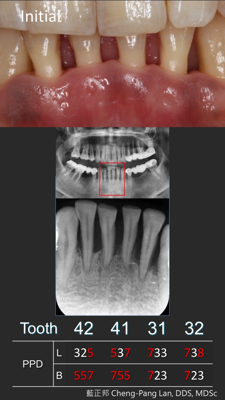 Non-surgical Therapy – Lower anterior teeth | 藍正邦 Cheng-Pang Lan, DDS, MDSc