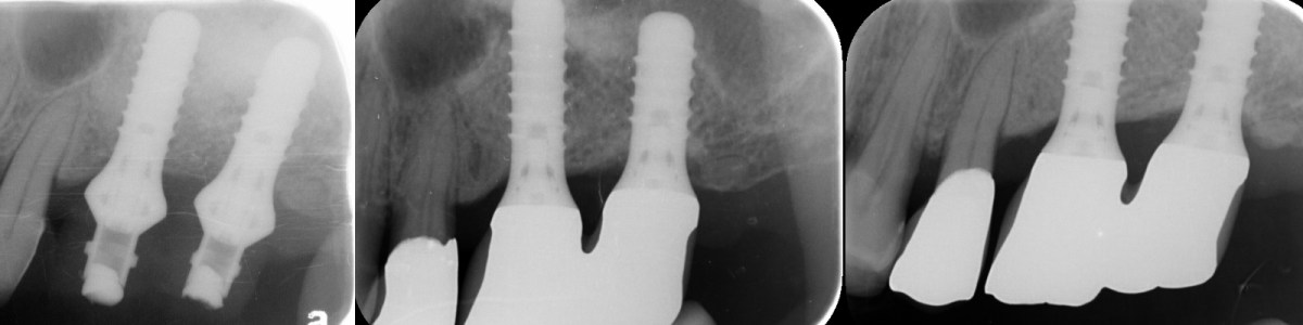 12 Years of Lateral-window Sinus Lift | 藍正邦 Cheng-Pang Lan, DDS, MDSc