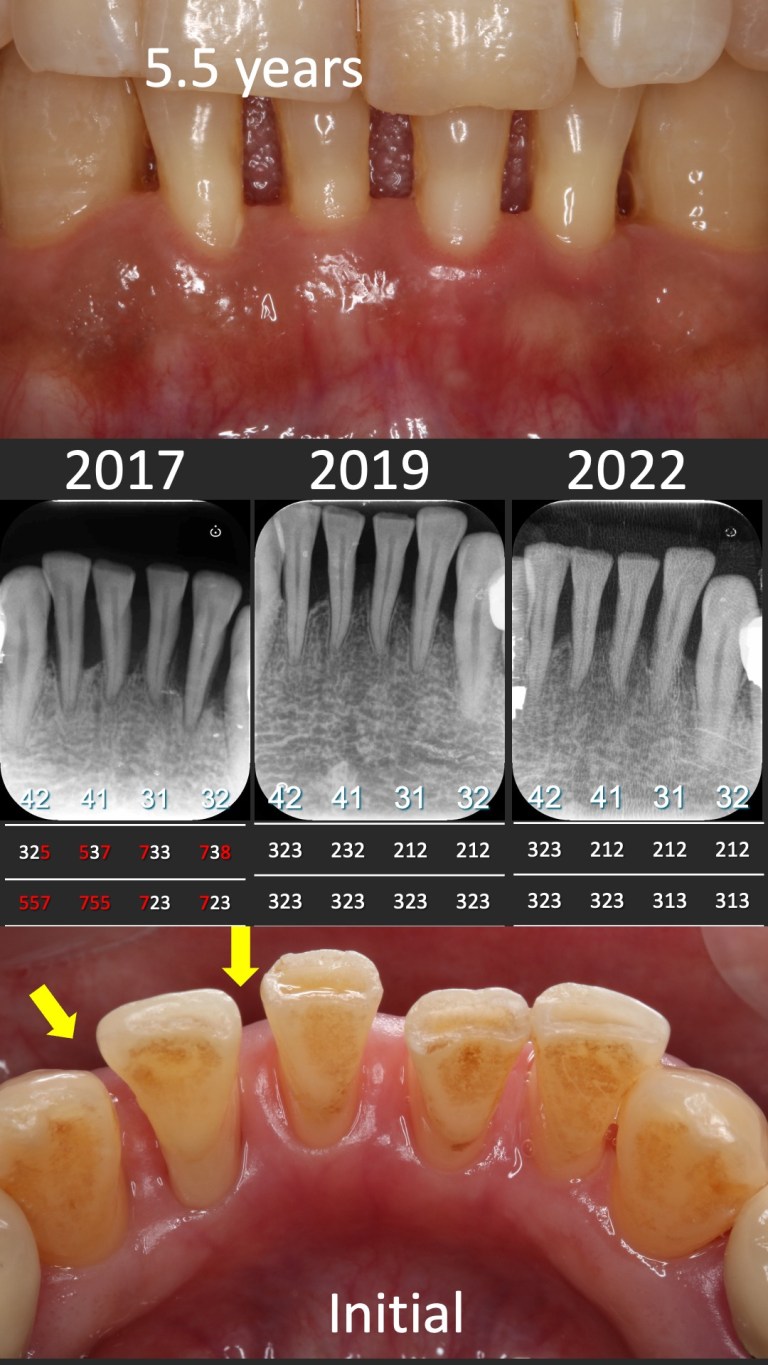 Non-surgical Therapy – Lower anterior teeth | 藍正邦 Cheng-Pang Lan, DDS, MDSc